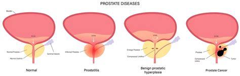 Protecting Your Prostate Tips For Mens Health Prime Magazine