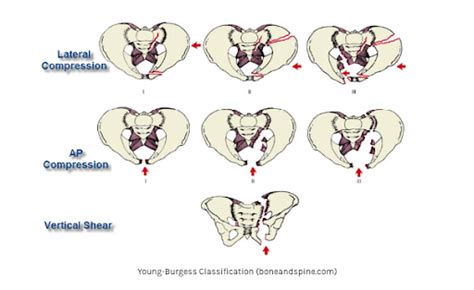 Pelvic Fractures — Nuem Blog