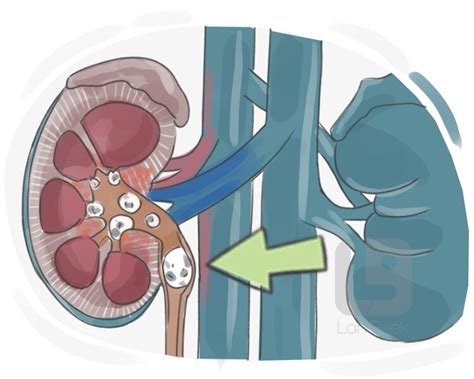 Definition And Meaning Of Renal Calculus Langeek