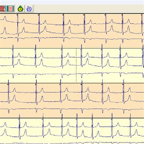 Atrial Fibrillation Episodes In External Event Recorder Monitoring Is Download Scientific