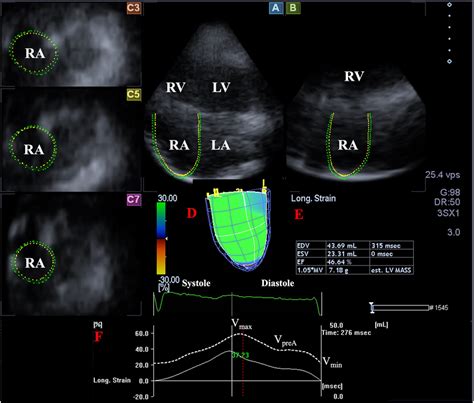 Three Dimensional 3d Speckle Tracking Echocardiographic Analysis Of