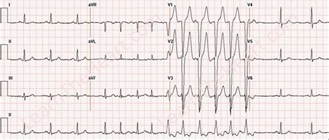 Rate Dependent Left Bundle Branch Block ECG Learn The Heart