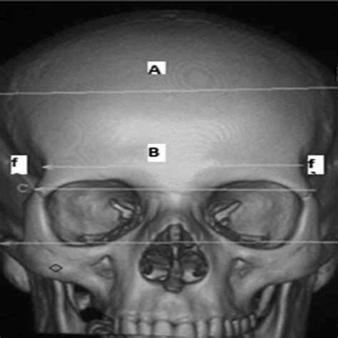 A Maximal Cranial Breadth B Minimal Frontal Breadth C Upper Facial