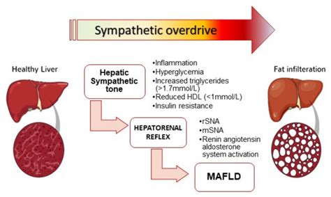 Mafld A Consequence Of Enhanced Hepatic Sympathetic Tone Sympathetic Download Scientific