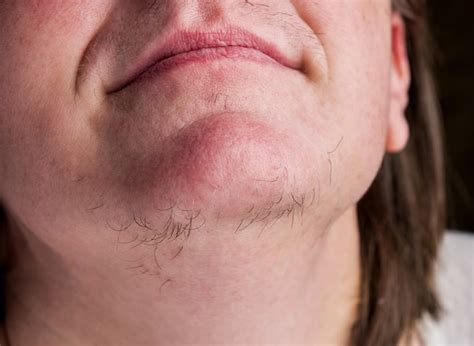 Hirsutism Bodilight Beauty Clinic Milton Keynes