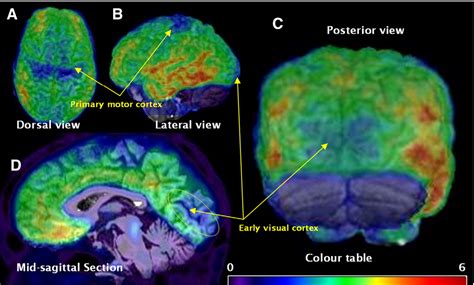 Figure 5 From Multimodal Imaging Of Human Early Visual Cortex By