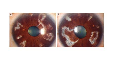 Wilmer Eye Institute Johns Hopkins Medicine On Linkedin Iris Atrophy