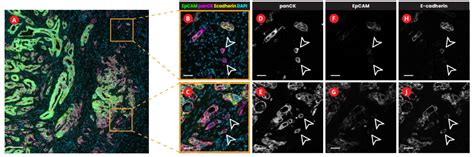 Deepening Understanding Of Tumor Budding In Colorectal Cancer For