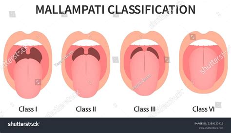 Mallampati Classification Score Oral Airway Intubation Stock Vector Royalty Free 2389123415