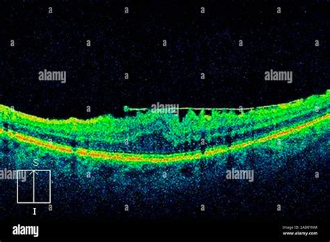 Epiretinal Membrane Optical Coherence Tomography Oct Scan Of A