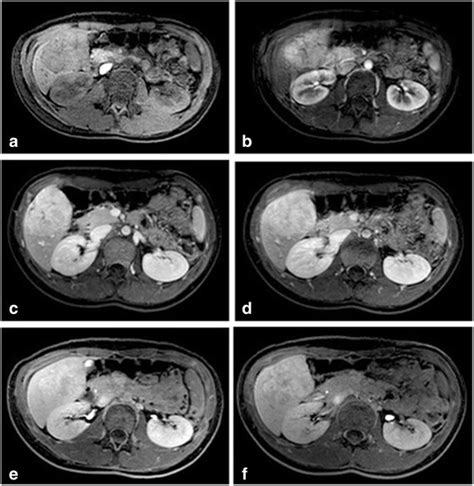 Mri Of Paediatric Liver Tumours How We Review And Report Pmc