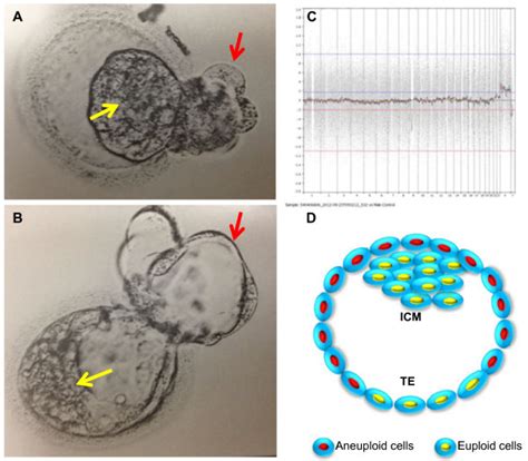 Morphology And Pgs Chart Of A Blastocyst Transferred A Blastocyst