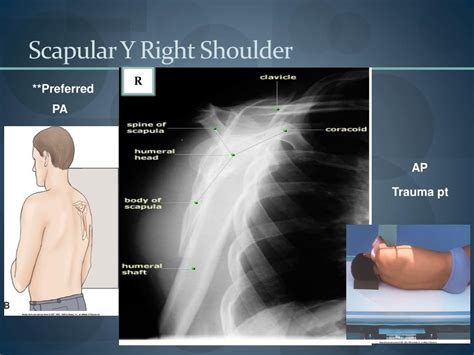 Blank Scapula Diagram