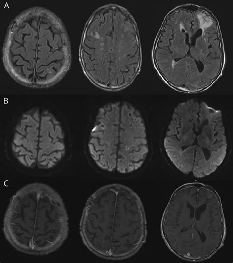 Clinical And Radiographic Resolution Of Multifocal Brain Abscesses