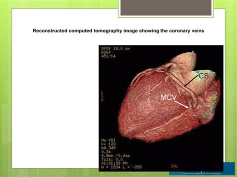 Coronary Sinus Anatomy Pptx