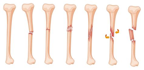 Tibial Shaft Fracture Causes Types Symptoms Diagnosis Treatment