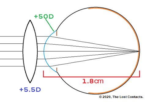The Optics Of Vision Lesson 7 Hyperopia The Lost Contacts