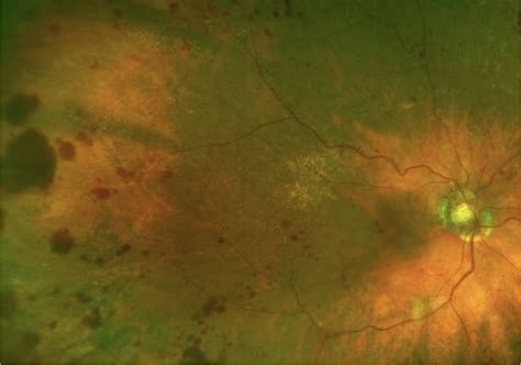Neovascular Glaucoma Viewpoint