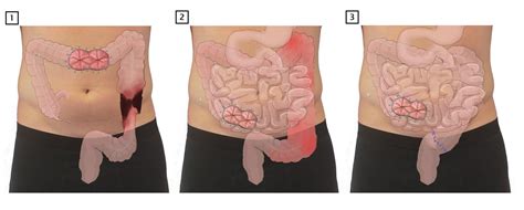 Laparoscopic Colon Resection And Colostomy With Hartmann