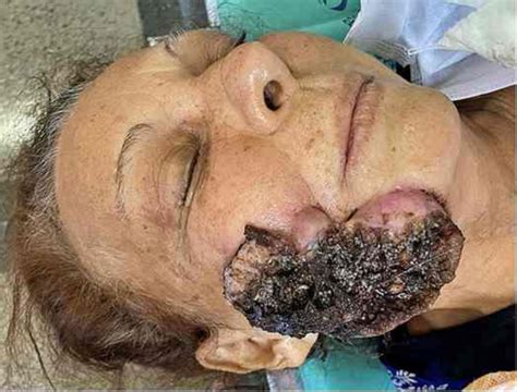 Clinical Aspect Of The Lesion In ¾ View Showing Raised Irregular And