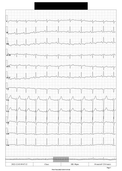 Afib Not Detected On Zio Patch R Askcardiology