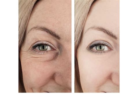 Under Eye Filler Ajax Under Eye Filler Before And After Results