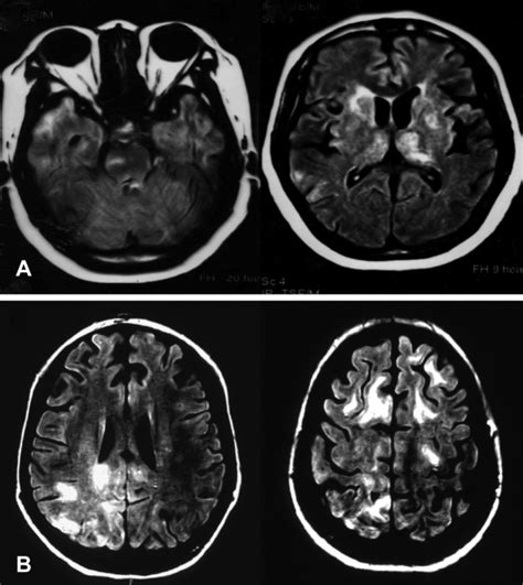 Representative Mri Findings In A Neurobehçets Disease Nbd Patient