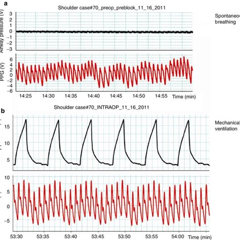 Pdf Photoplethysmography Analysis Of The Pulse Oximeter Waveform