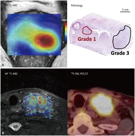 Hyperpolarized Carbon 13 Magnetic Resonance Imaging Technical Considerations And Clinical