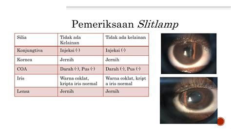 Ppt Case Report Mata Aini Pptx