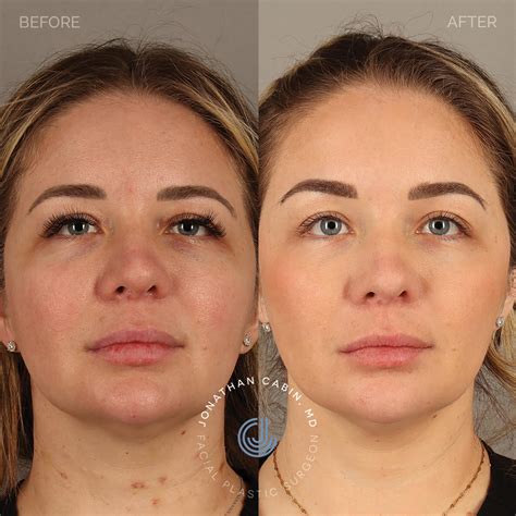 Endoscopic Brow Lift CabinMD Facial Plastics Aesthetics