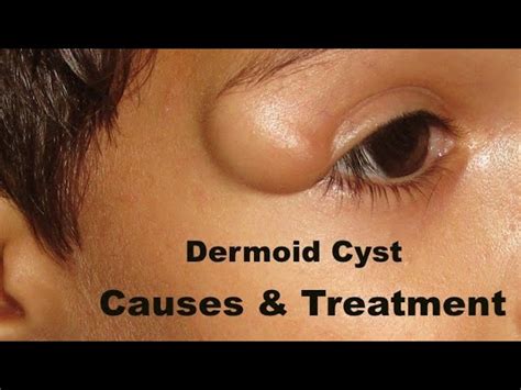 Dermoid Cyst Forehead