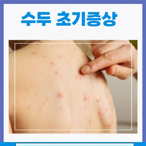 수두 초기증상 감염경로 진단 치료 예방 네이버 블로그