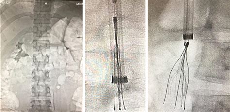 Ivc Filter Difficult Removal