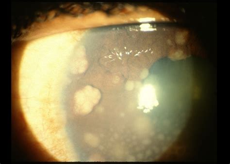 Sarcoid Bussaca Iris Nodules Retina Image Bank