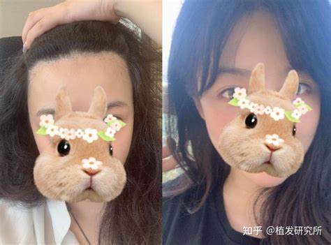 北京植发医生哪个好手把手教你选靠谱医生 知乎