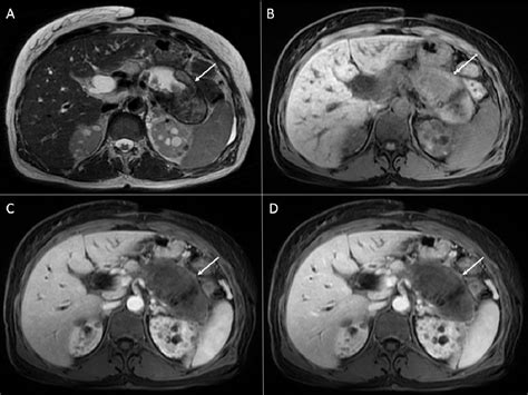 Figure 13 From The Role Of Mri In The Diagnosis Of Solid Pseudopapillary Neoplasm Of The