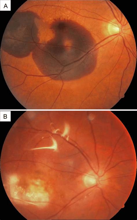 Subretinal Hemorrhage