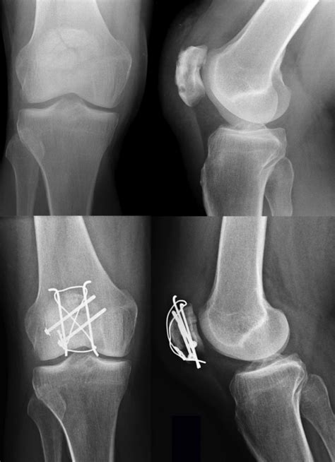 Xray Tech Times Patella Fracture Xray Tech X Ray
