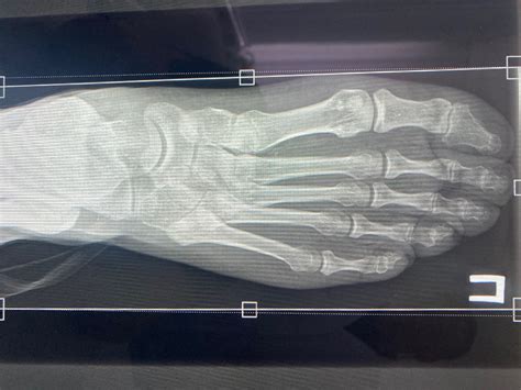 Артроз 1 степени Вопрос ревматологу 03 Онлайн