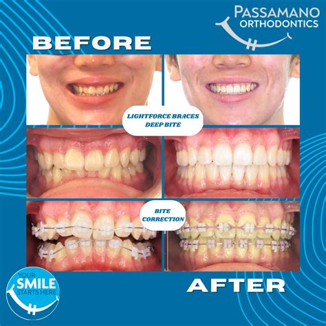 Custom Braces With Deep Bite FAST BRACES Passamano Orthodontics