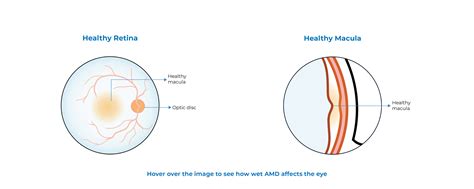 Wamd Wet Age Related Macular Degeneration Kodiak Sciences
