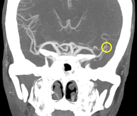 Solitaire 3x20 And 6x40 In Simultaneous 2 Branch Occlusions With Tici 2c Reperfusion In First Pass