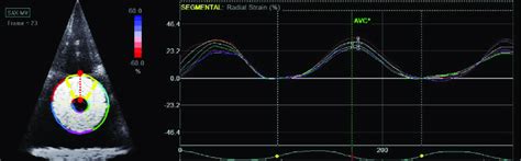Speckle Tracking Echography Of The Phantom In Short Axis View The Download Scientific Diagram