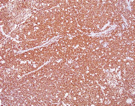 Pathology Outlines Burkitt Lymphoma