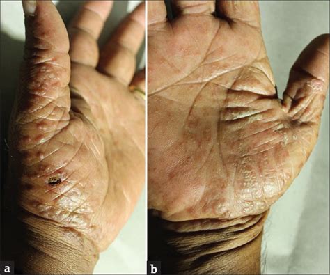 Acral Erythematous Papules In Dengue Fever Atypical Presentation Of Aquagenic Syringeal