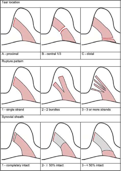 Three Digit Acl Rupture Classification The First Digit Describes The