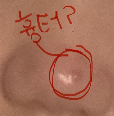 여드름 흉터 인가요 지식in