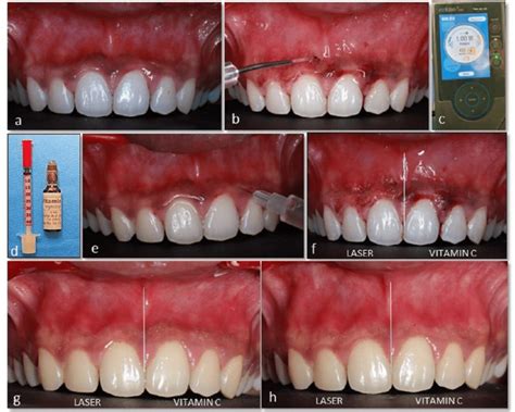 Comparison Of Various Minimally Invasive Techniques For The Management