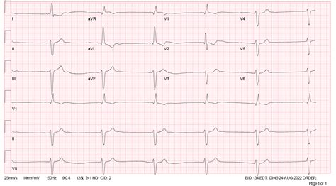 Digoxin Toxicity A Case For Not Checking Repeat Levels Shm Abstracts Society Of Hospital